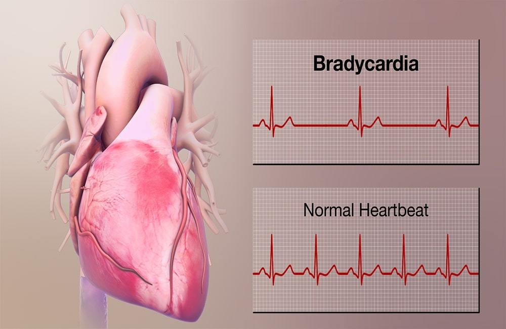 Low Heart Rate - When Should I Worry about Bradycardia – Wellue