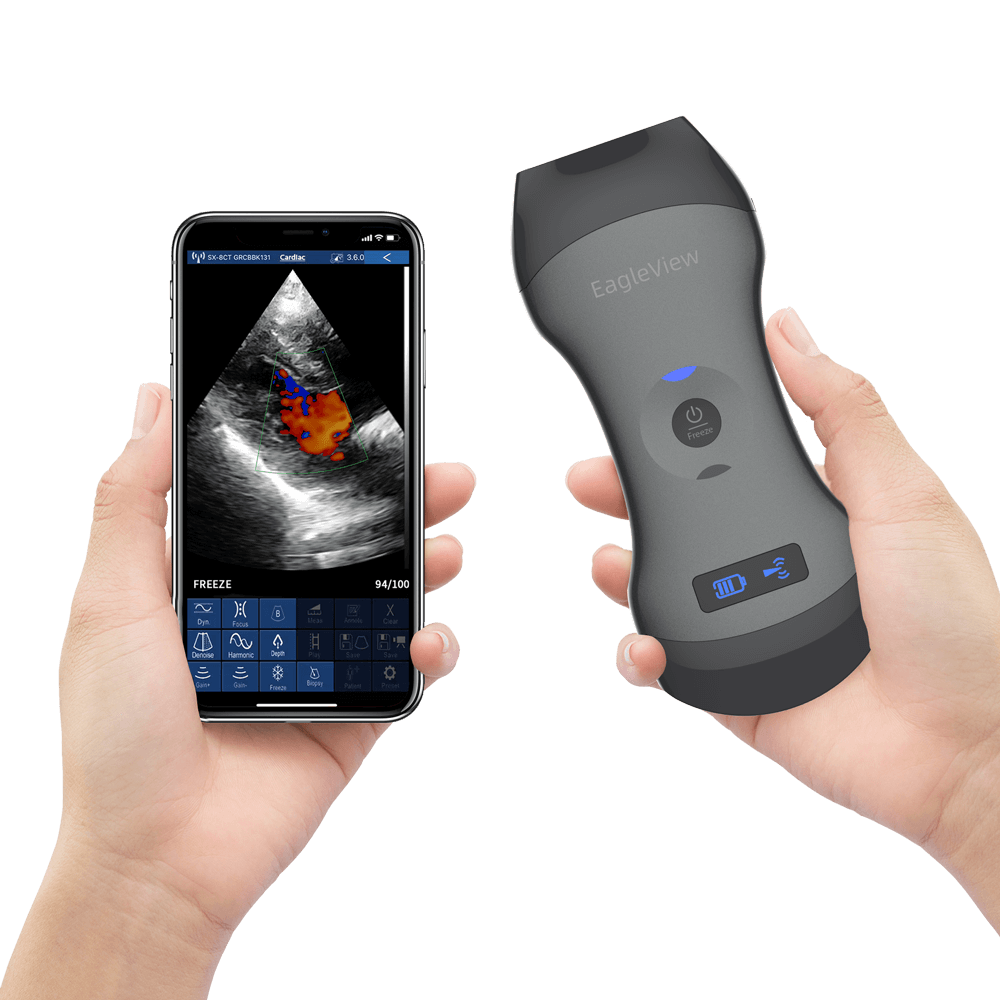 EagleView portable doppler ultrasound, whole-body point-of-care imaging ...